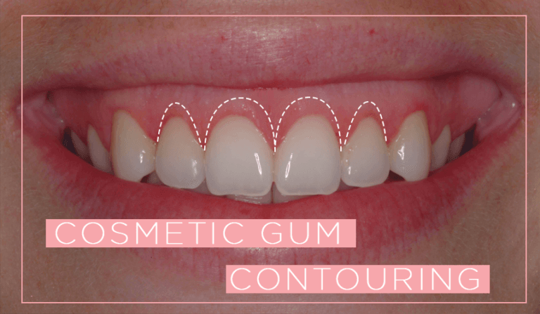 Cosmetic Gum Contouring: Living With A ‘Gummy Smile’ » Top Cosmetic ...