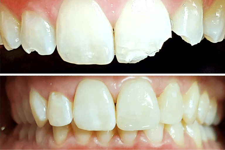 Tooth Reshaping: How Cosmetic Teeth Contouring Works