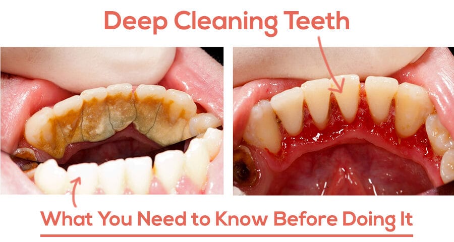 Deep Cleaning Teeth: What You Need to Know Before Doing It