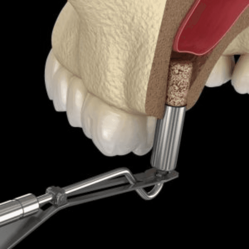 Bone Grafting: 5 Essential Facts For A Brighter Smile