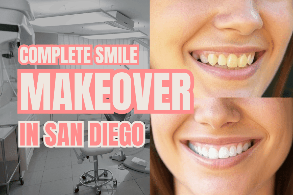 How to Transform My Smile: Complete Smile Makeover in San Diego